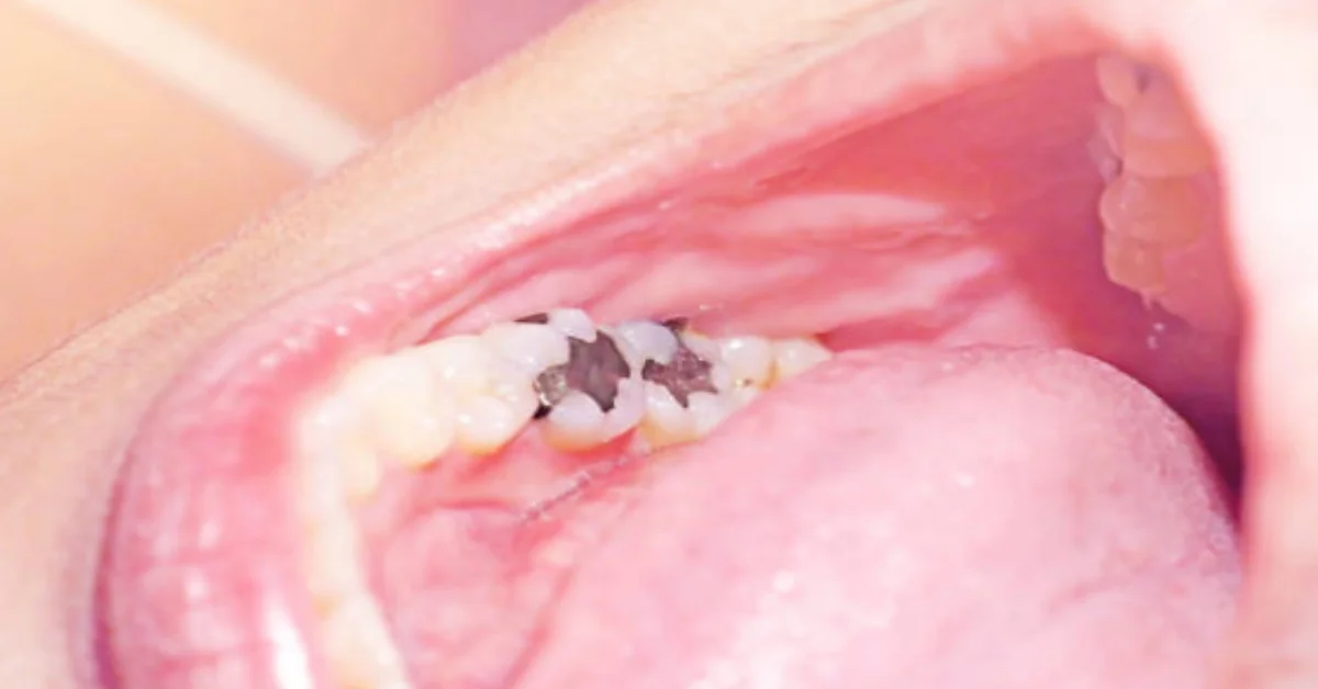 Dental Amalgam: The Best Filling Material - Your Ultimate Health ...