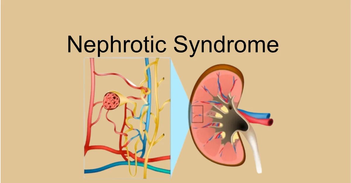 Understanding Nephrotic Syndrome - Your Ultimate Health Resource - Join ...