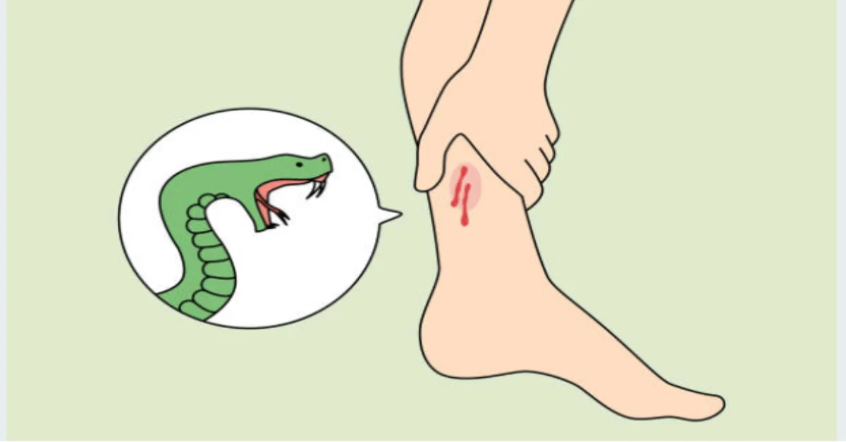 Essential Guide to Snake Bite Management - Your Ultimate Health ...